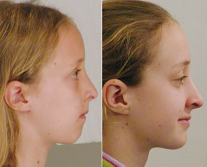 Causes of Malocclusion – TMD – Occlusion