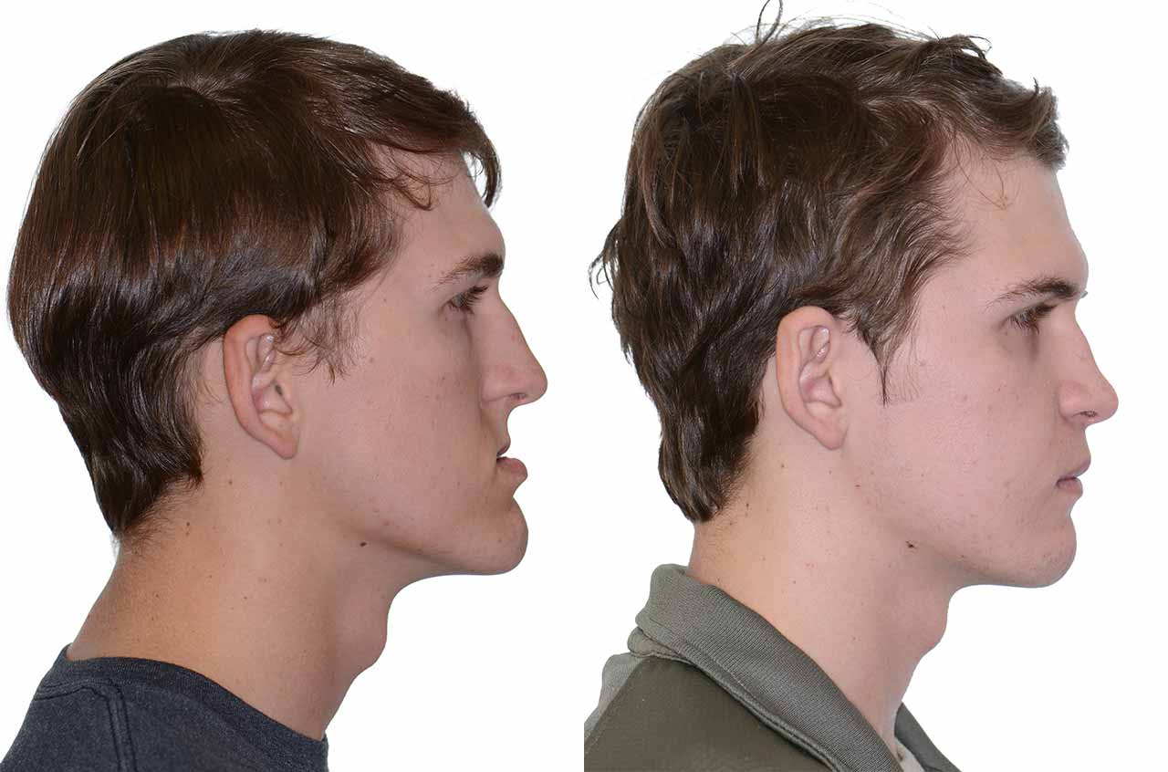 The Work of John Mew – Orthotropics – TMD – Occlusion