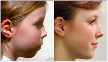 The Work of John Mew – Orthotropics – TMD – Occlusion