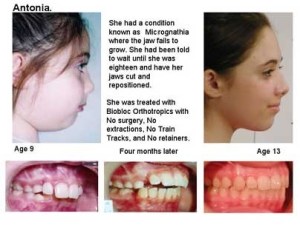 The Work of John Mew – Orthotropics – TMD – Occlusion