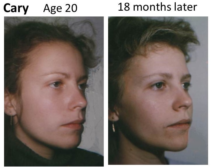 Maxilla: Essential Bone for Body’s Health – TMD – Occlusion