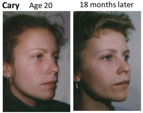 Maxilla: Essential Bone for Body’s Health – TMD – Occlusion