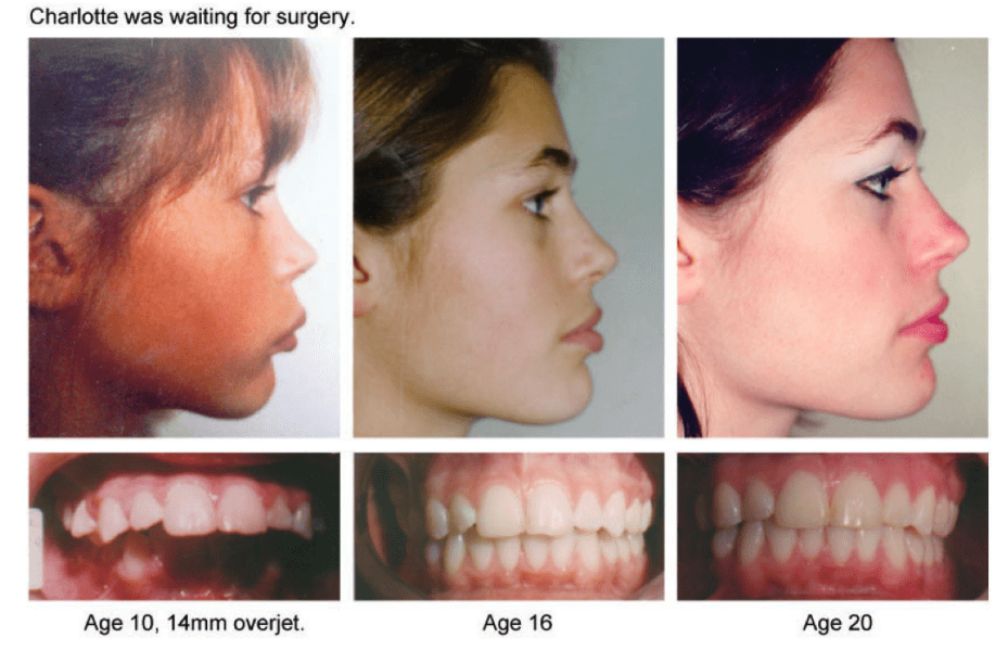 The Work of John Mew – Orthotropics – TMD – Occlusion