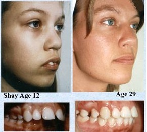The Work of John Mew – Orthotropics – TMD – Occlusion
