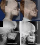 Maxilla: Essential Bone for Body’s Health – TMD – Occlusion