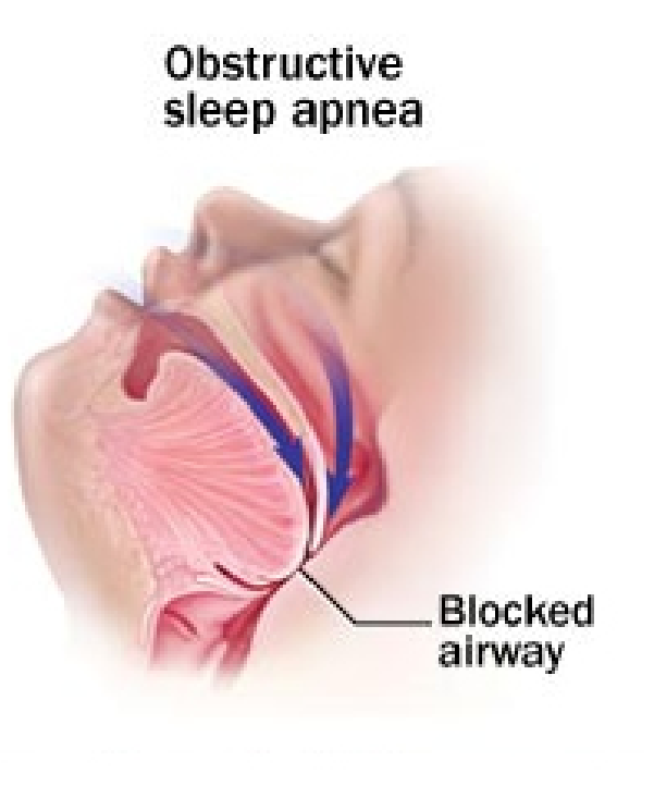 Snoring and Sleep Apnea – TMD – Occlusion