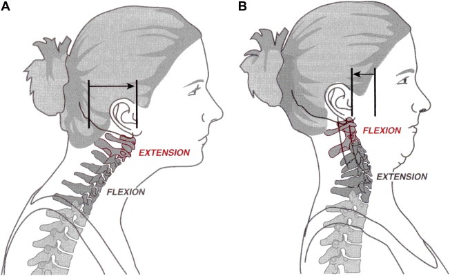 Forward Head Posture, Kyphosis and Lordosis – TMD – Occlusion