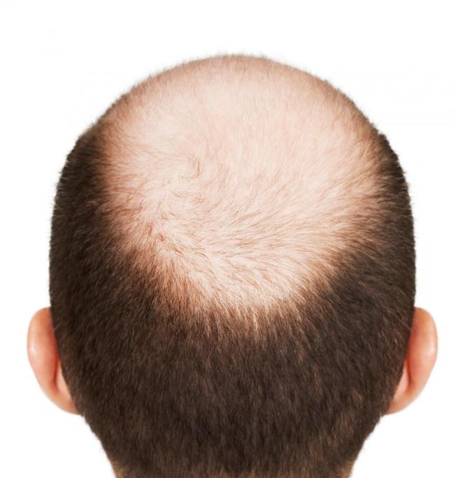 More on Hair Loss: Part I – TMD – Occlusion