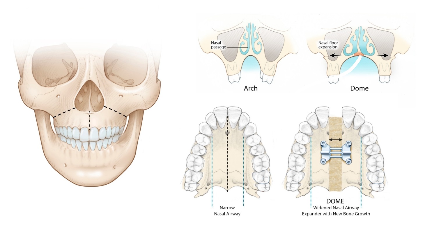 RPE/RME vs MARPE/MSE/EASE vs SARPE/DOME – TMD – Occlusion