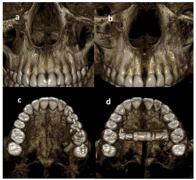 RPE/RME vs MARPE/MSE/EASE vs SARPE/DOME – TMD – Occlusion