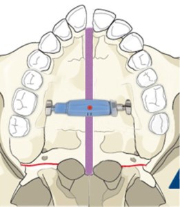 RPE/RME vs MARPE/MSE/EASE vs SARPE/DOME – TMD – Occlusion