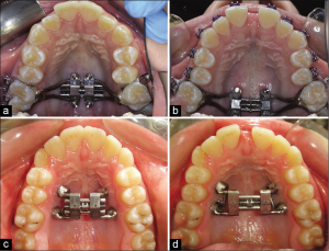 RPE/RME vs MARPE/MSE/EASE vs SARPE/DOME – TMD – Occlusion