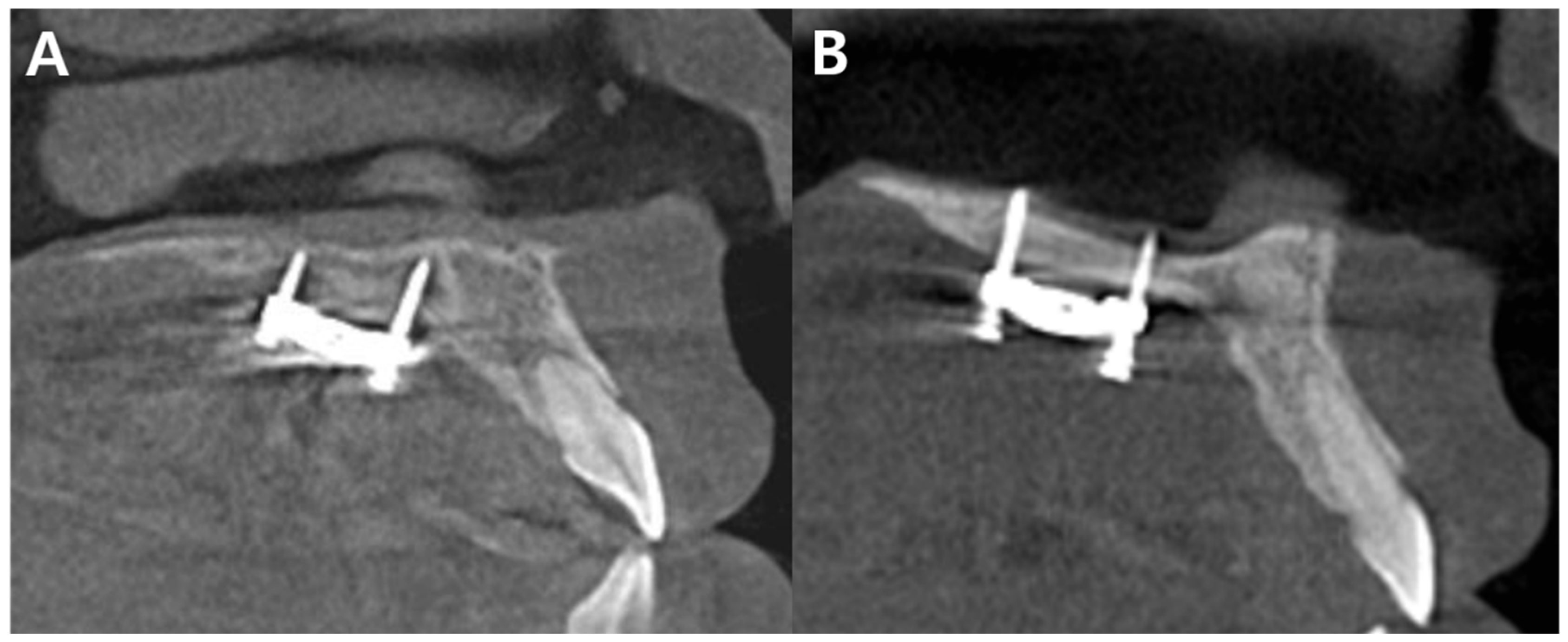 RPE/RME vs MARPE/MSE/EASE vs SARPE/DOME – TMD – Occlusion