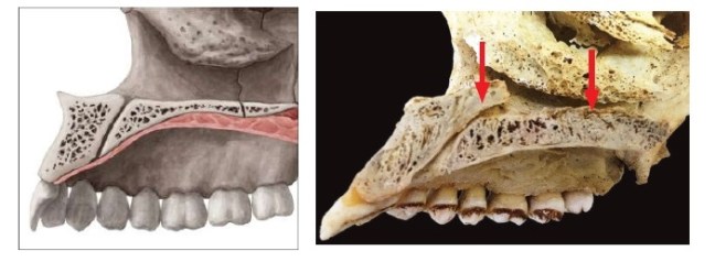 RPE/RME vs MARPE/MSE/EASE vs SARPE/DOME – TMD – Occlusion