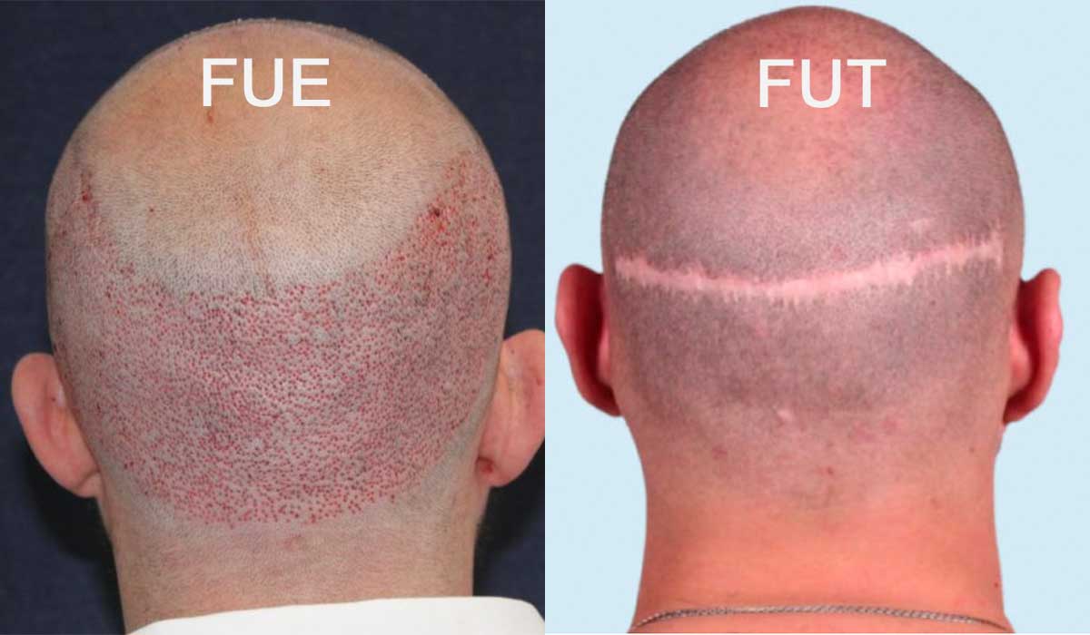 Mo Salah’s Hair Transplant – TMD – Occlusion